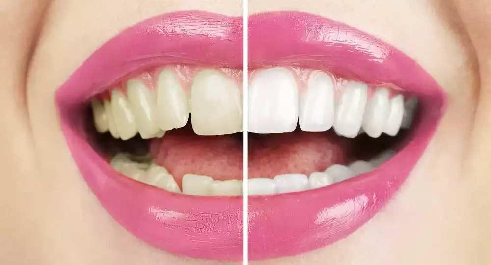 Are Yellow Teeth Healthy? What You Need to Know