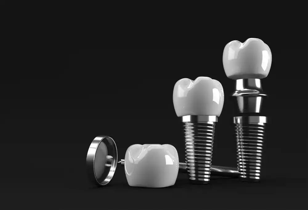 Why Opt for Titanium Tooth Replacement Solutions?