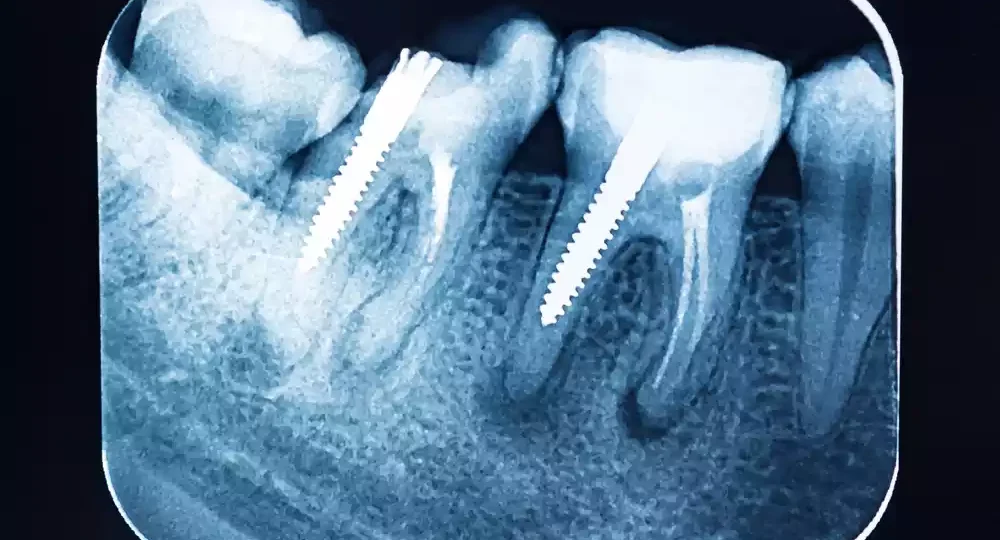Identify Failed Implant Symptoms Early to Avoid Risks